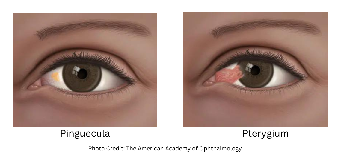 Newsletter: UV Safety Awareness Month - Eye Centers of Racine & Kenosha